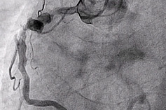 CONQUEROR™ Trap - Trapping balloon Catheter - APT Medical