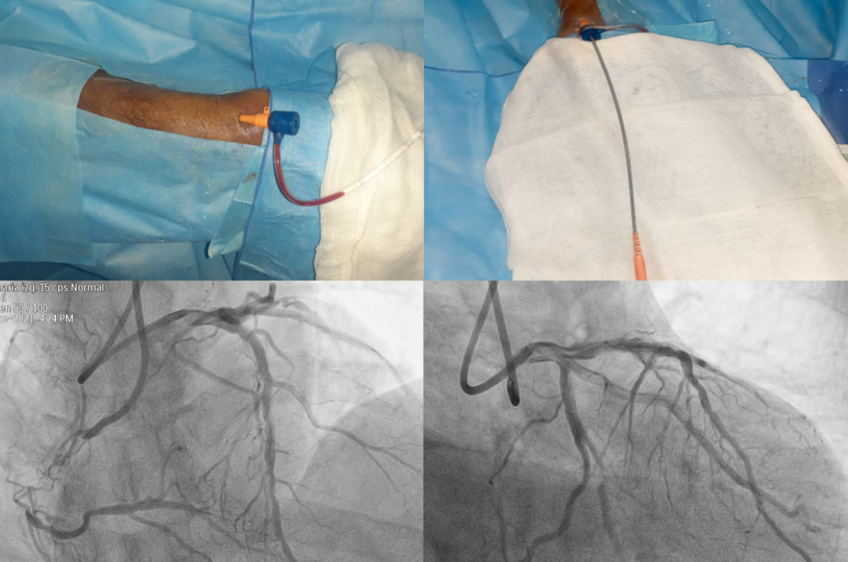 Expressman™ Guiding Catheter for PCI Procedure - APT Medical